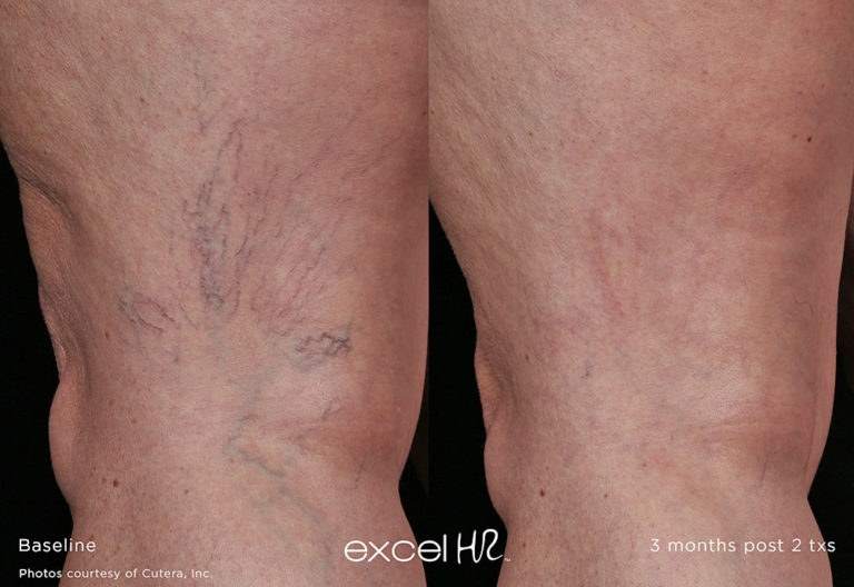 Laser Vein Removal | Shape Me Up